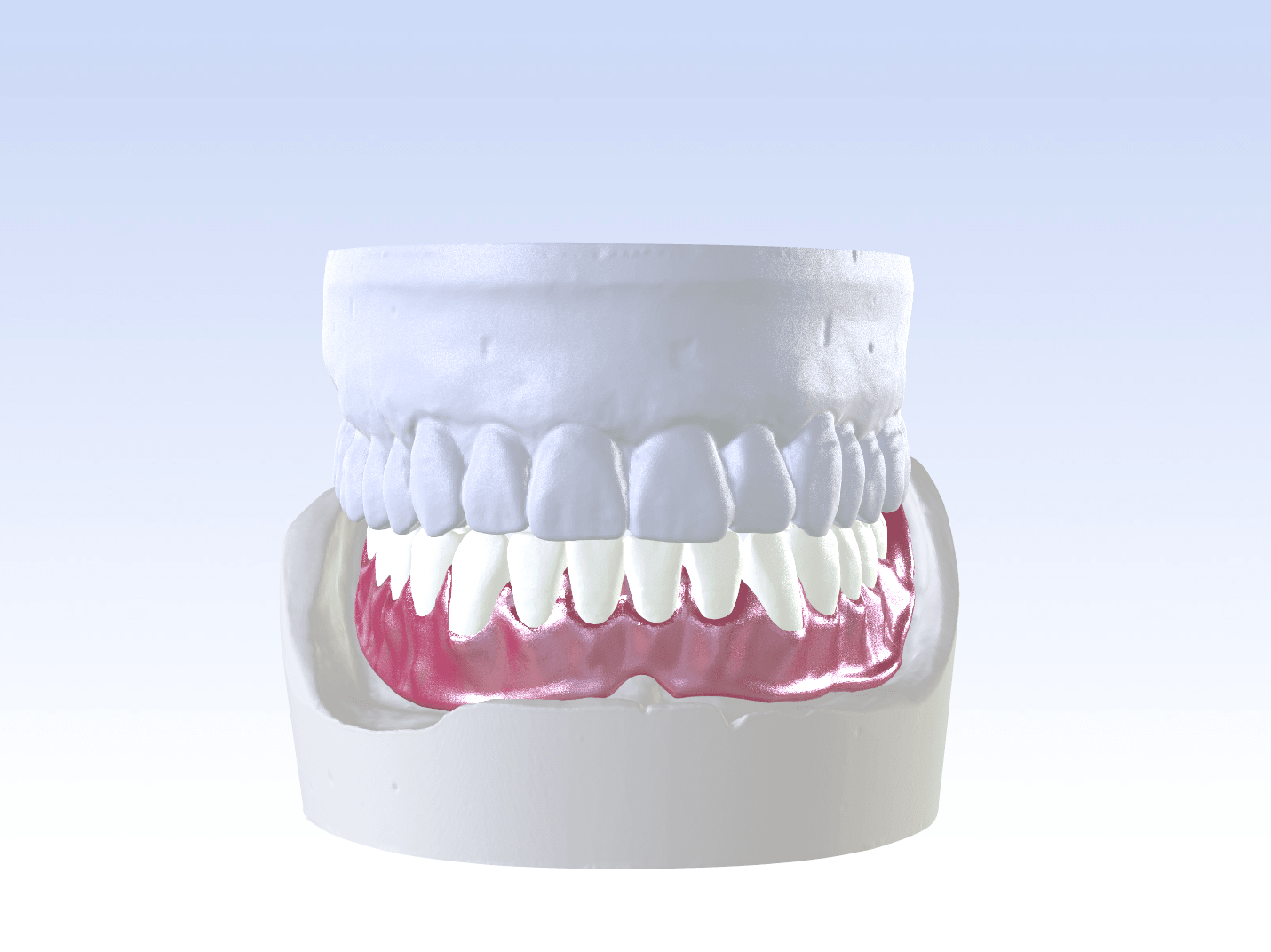Fichier STL Digital Single Jaw Full Denture 🦷・Modèle pour impression 3D ...