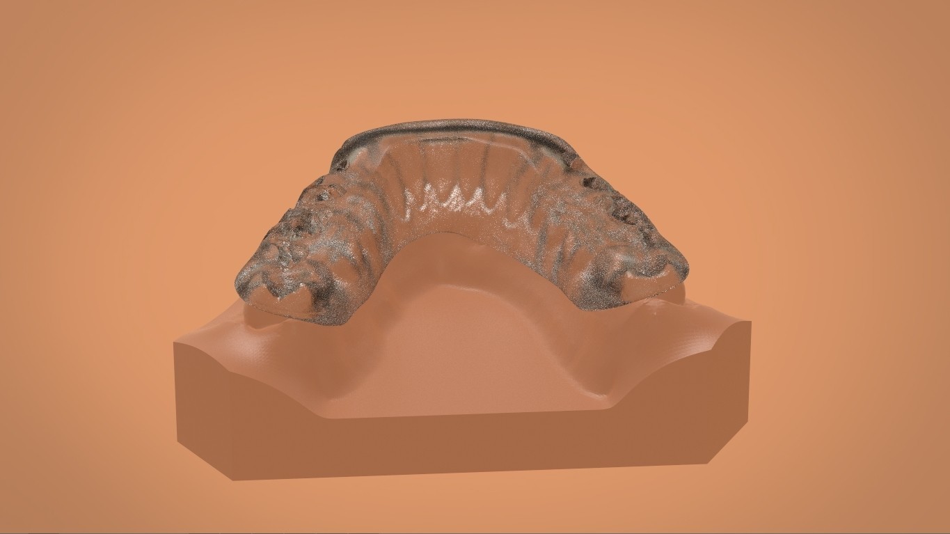 STL-Datei Digital Mandibular Tanner Splint 🦷・Modell für 3D-Drucker zum Herunterladen・Cults