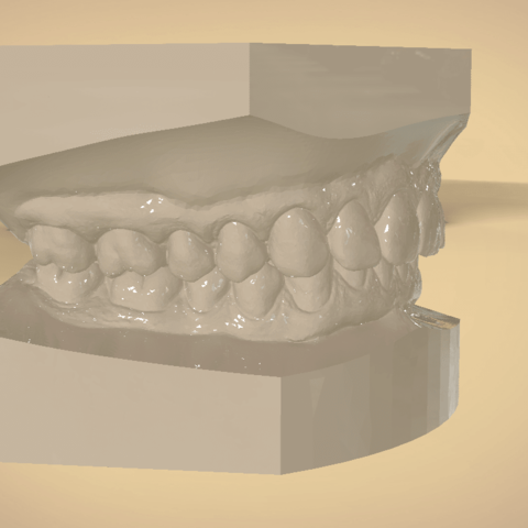 Download STL files Digital Orthodontic Study Models with Virtual Bases ...