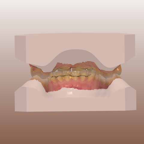 Download STL file Digital ABO Planning Study Models ・ Cults