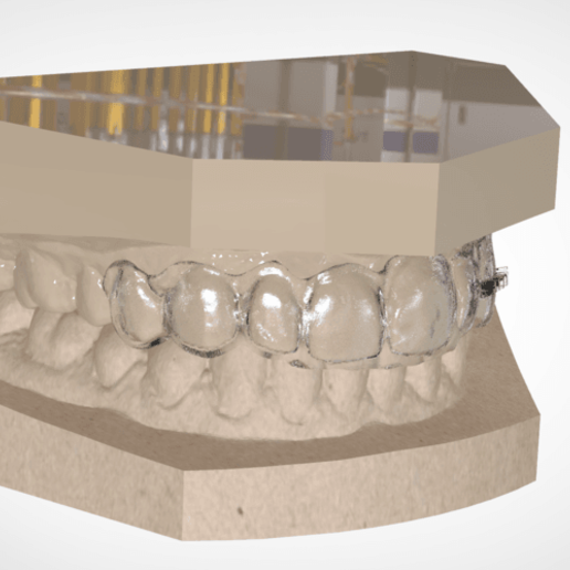 Download 3D printing files Digital Ortho Mini Deprogrammer Splint ・ Cults