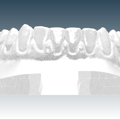 Download STL file Digital ABO Planning Study Models ・ Cults