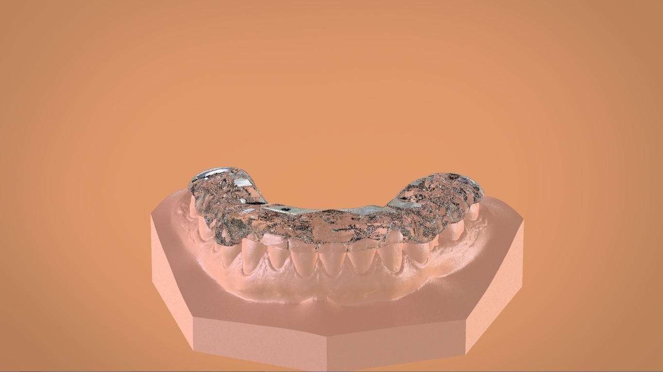 STL-Datei Digital Mandibular Tanner Splint 🦷・Modell für 3D-Drucker zum Herunterladen・Cults
