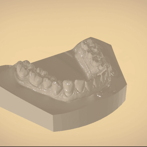 Download STL files Digital Orthodontic Study Models with Virtual Bases ...
