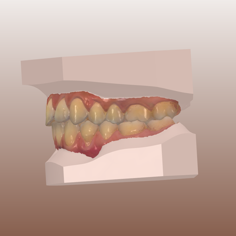Download STL file Digital ABO Planning Study Models ・ Cults