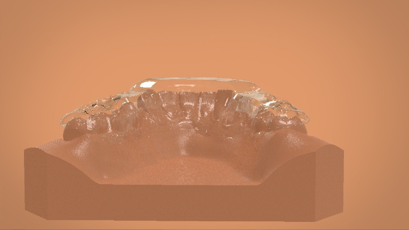 STL-Datei Digital Mandibular Tanner Splint 🦷・Modell für 3D-Drucker zum Herunterladen・Cults