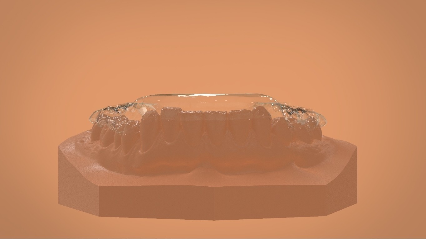 STL-Datei Digital Mandibular Tanner Splint 🦷・Modell für 3D-Drucker zum Herunterladen・Cults