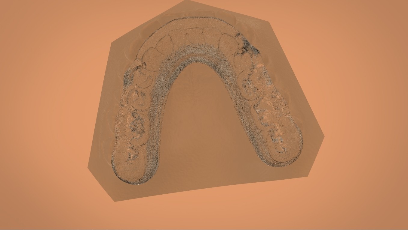 STL-Datei Digital Mandibular Tanner Splint 🦷・Modell für 3D-Drucker zum Herunterladen・Cults
