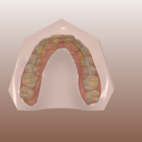Download STL file Digital ABO Planning Study Models ・ Cults