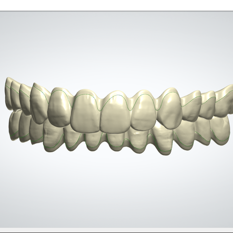 Download STL file Digital Full Dentures with Combined Glue-in Teeth ...