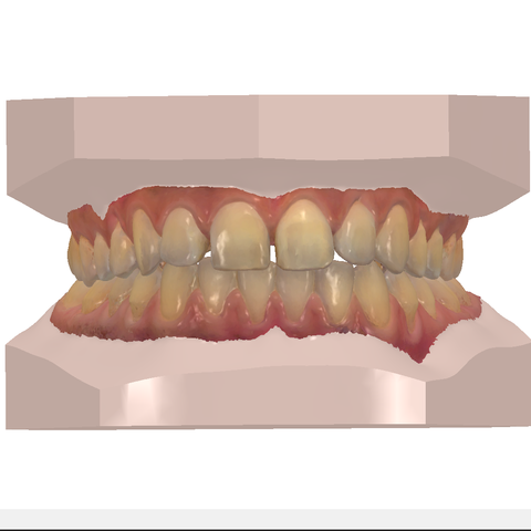 Download STL file Digital ABO Planning Study Models ・ Cults