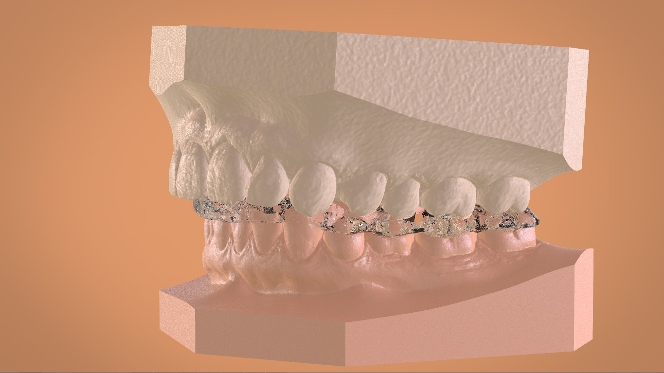 STL-Datei Digital Mandibular Tanner Splint 🦷・Modell für 3D-Drucker zum Herunterladen・Cults