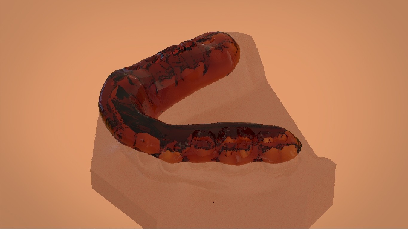 STL-Datei Digital Mandibular Tanner Splint 🦷・Modell für 3D-Drucker zum Herunterladen・Cults