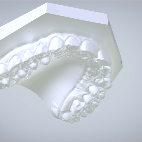 Download STL file Digital ABO Planning Study Models ・ Cults