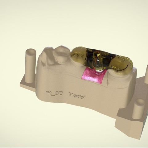 Download OBJ file Digital Implant Model with Positioning Guide • 3D ...