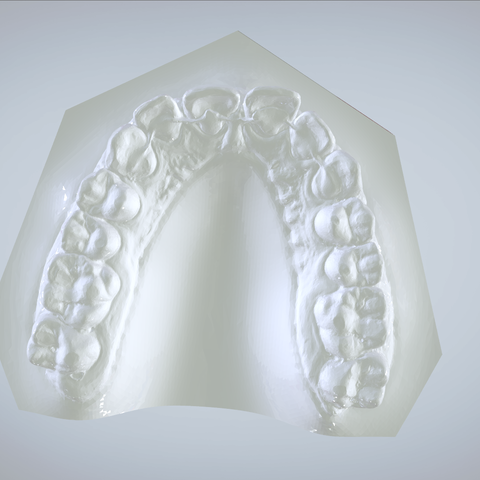 Download STL file Digital ABO Planning Study Models ・ Cults