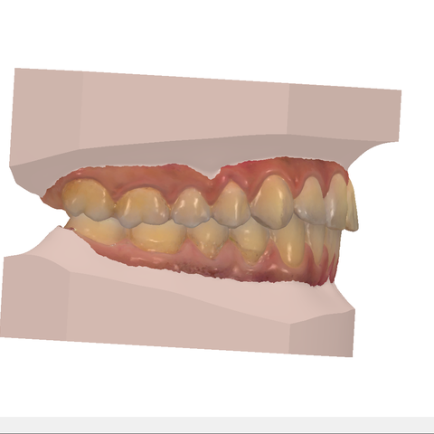 Download STL file Digital ABO Planning Study Models ・ Cults