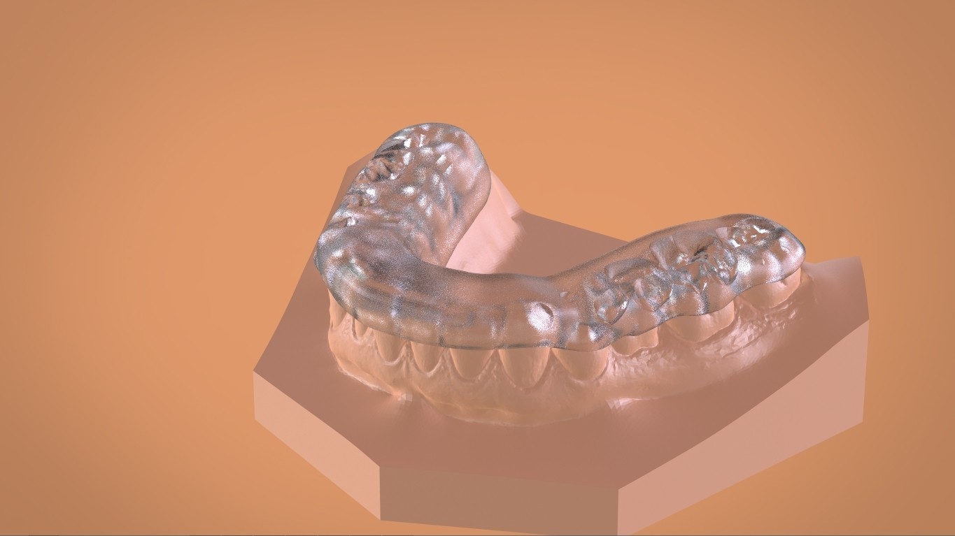 STL-Datei Digital Mandibular Tanner Splint 🦷・Modell für 3D-Drucker zum Herunterladen・Cults