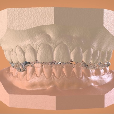 Download STL file Digital Mandibular Tanner Splint ・ Cults