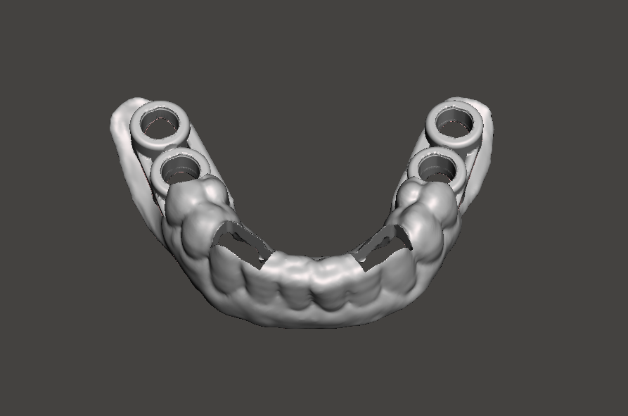 STL file SURGICAL SPLINT FOR GUIDED SURGERY・3D printable model to ...