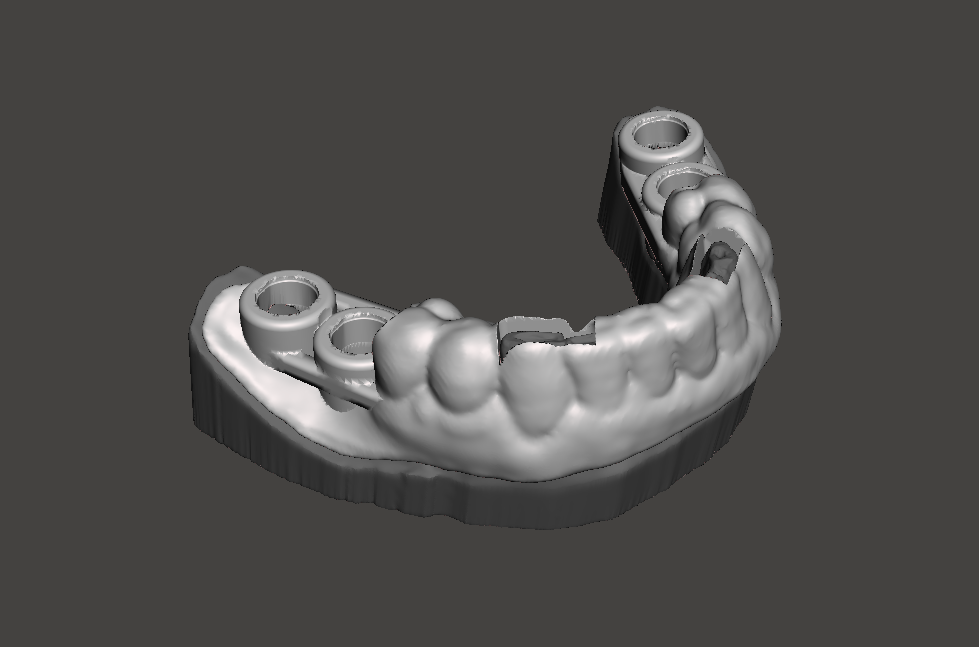 STL file SURGICAL SPLINT FOR GUIDED SURGERY・3D printable model to ...