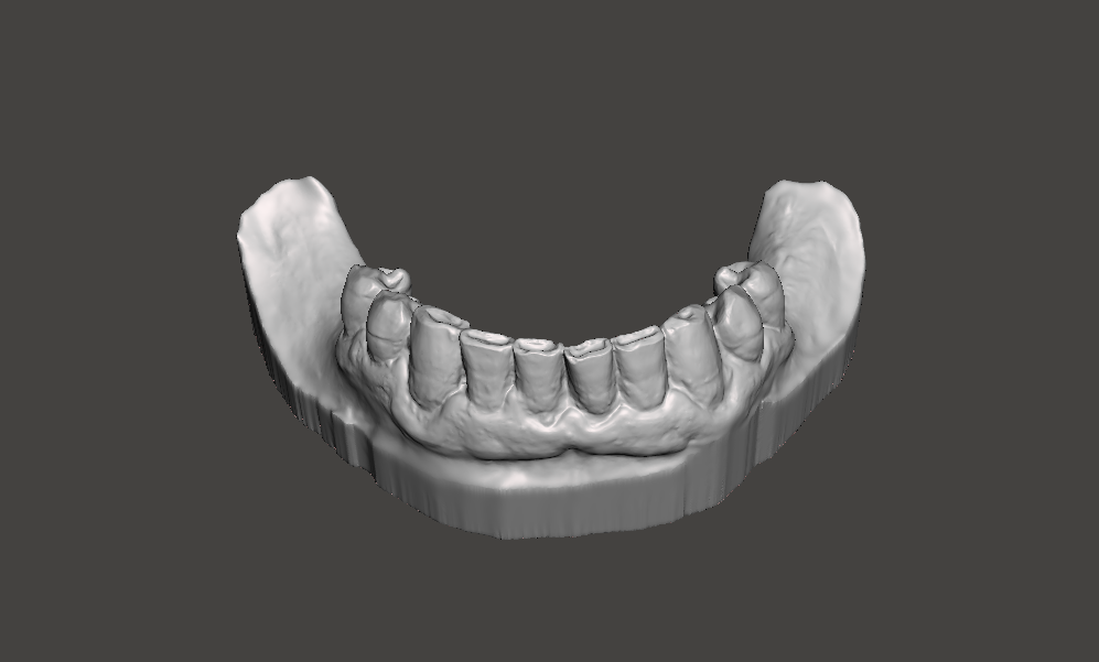 STL file SURGICAL SPLINT FOR GUIDED SURGERY・3D printable model to ...