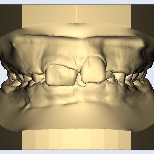 Download STL file big central teeth - dental fusion • 3D printer design ...