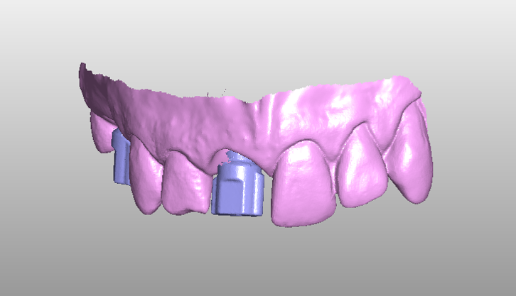 STL file Implant dental model A・3D print object to download・Cults