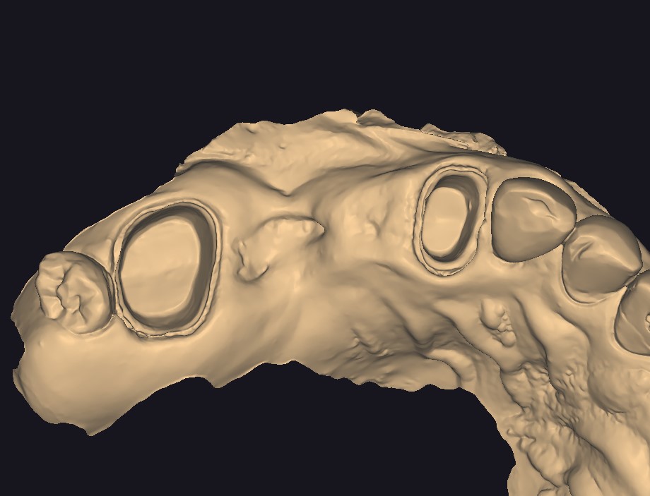 STL file Intraoral scan good tooth preparation・Design to download and ...