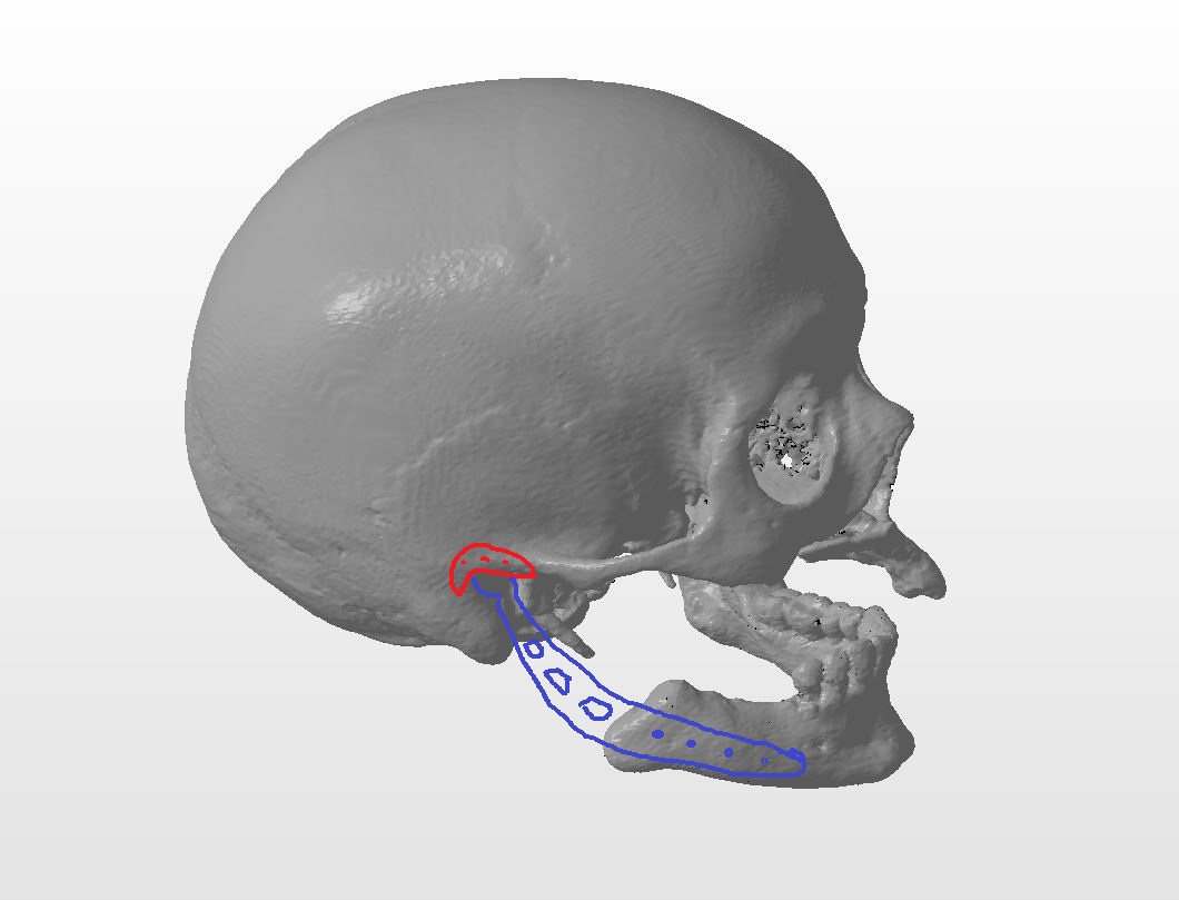 STL file Individual prosthesis for jaw reconstruction (example of a ...