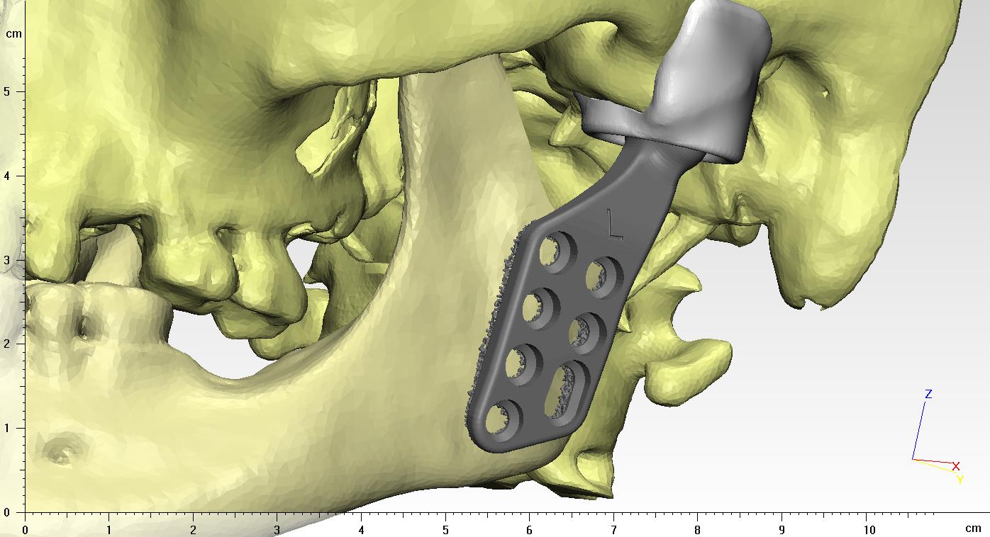 STL file Individual TMJ prosthesis (real operation)・3D print design to ...