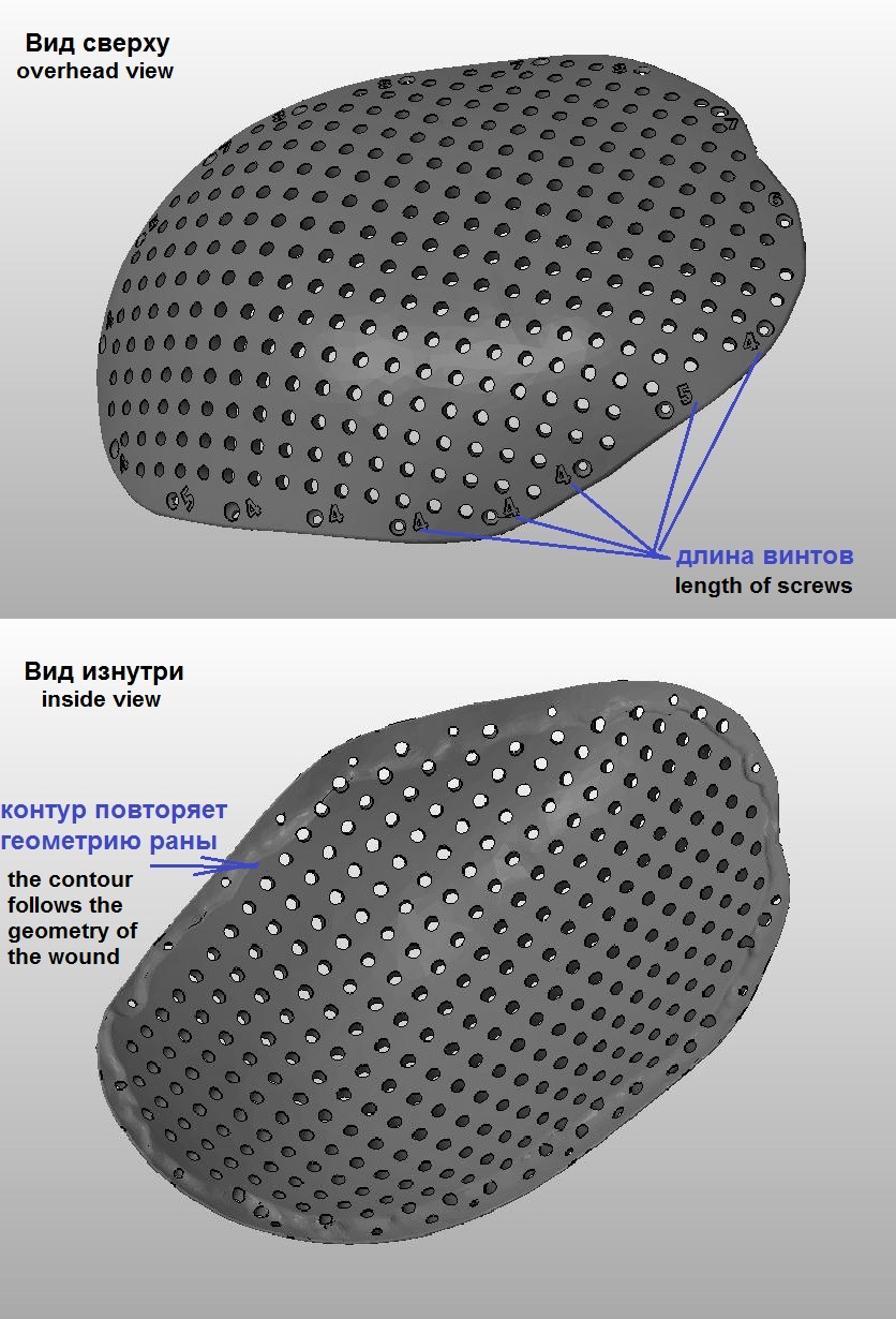 Free STL file The plate for cranioplasty (real operation)・3D printing ...