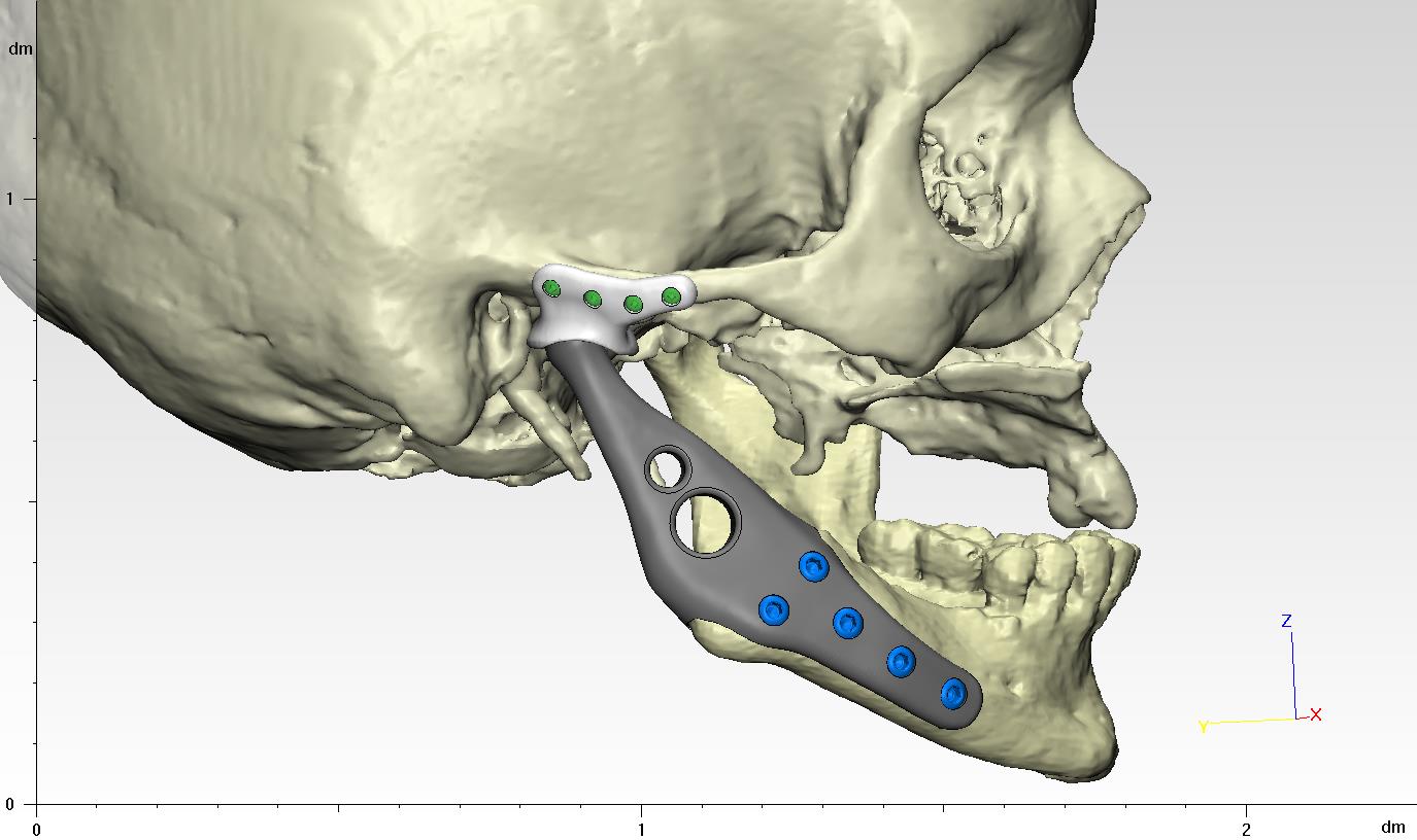 STL file Individual prosthesis for jaw reconstruction (example of a ...
