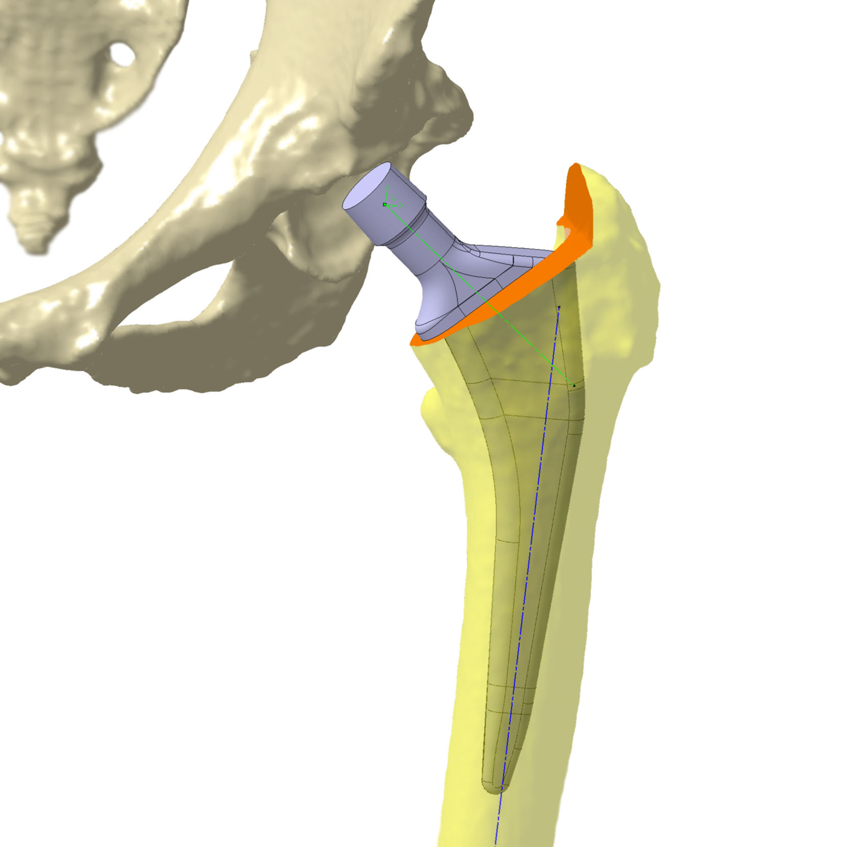 Stl File Tibia Implant Real Layout For Training ・model To Download And