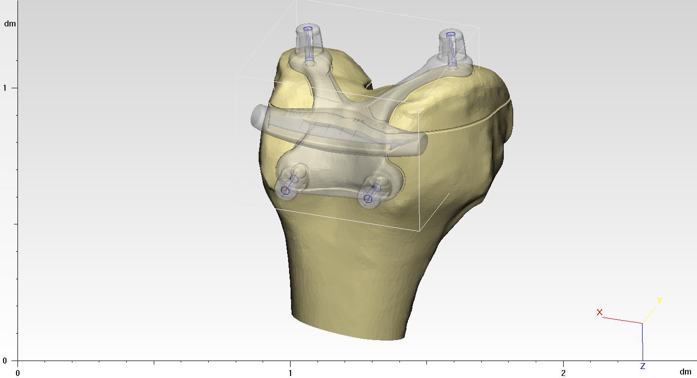 STL file Knee joint prosthesis with guides (sample of individual ...