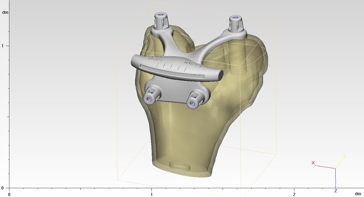 STL file Knee joint prosthesis with guides (sample of individual ...