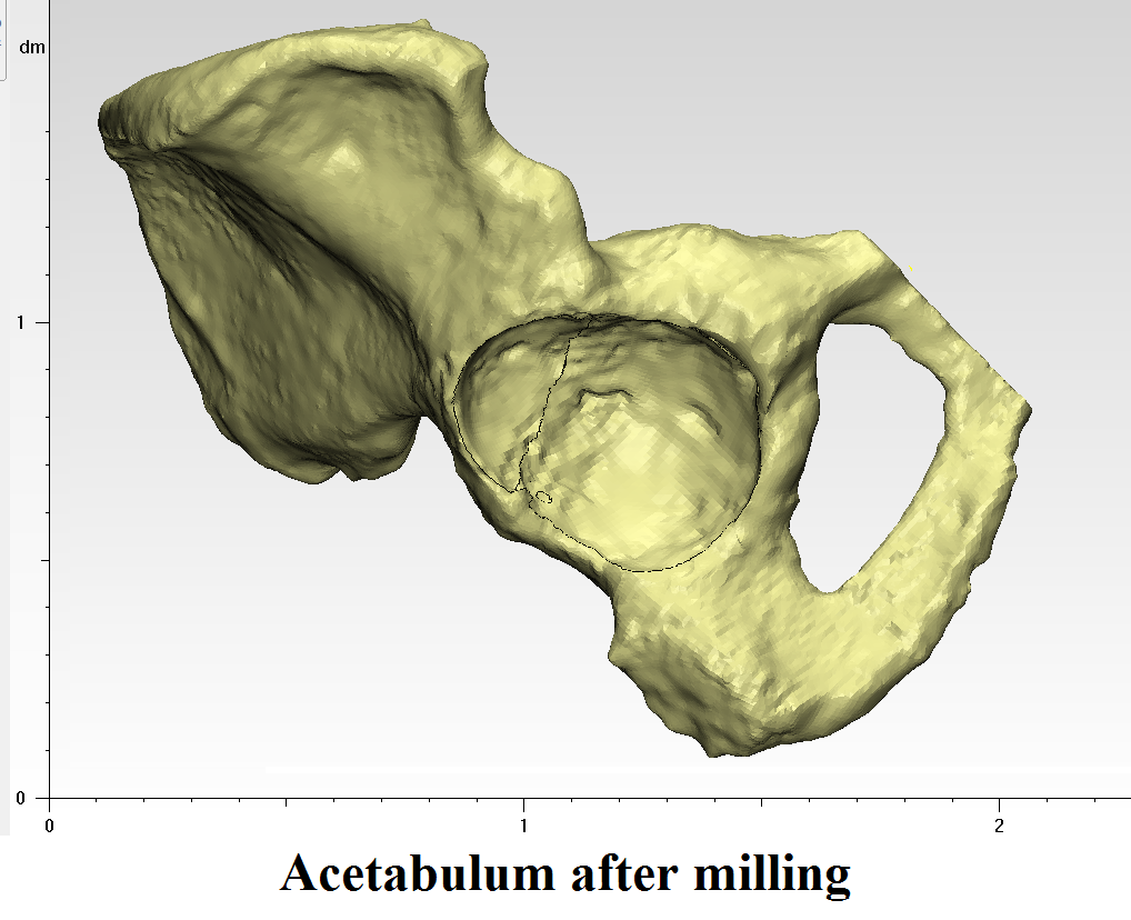 Free STL file Acetabulum augment (example of individual prosthetic) 💊 ...