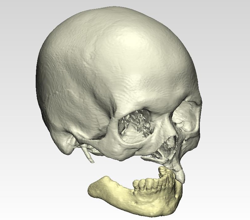 3d Printed Jaw Prosthetic