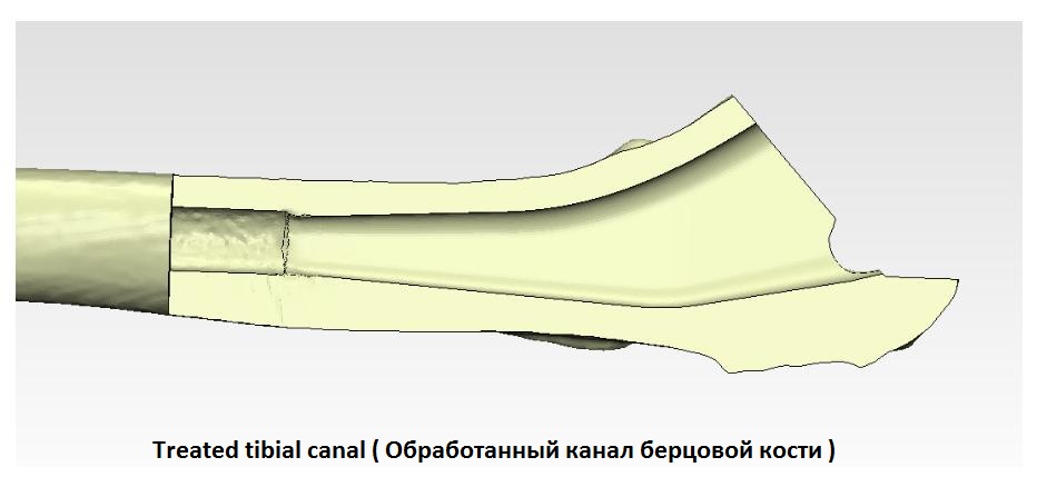 Archivo STL Implante de tibia (diseño real para entrenamiento)・Objeto ...