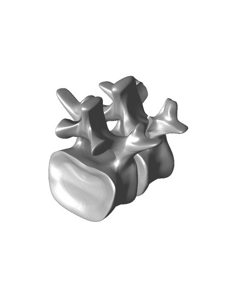 Free 3D file Spondylolysis unilateral teaching example・Object to ...