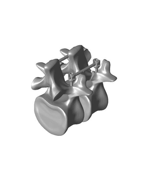 Free 3D file Spondy pedicle screws and rod posterior only fixation ...