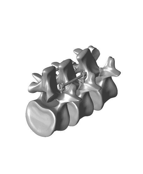 Free 3D file Spondy double deker pedicle below pars models.stl・3D ...