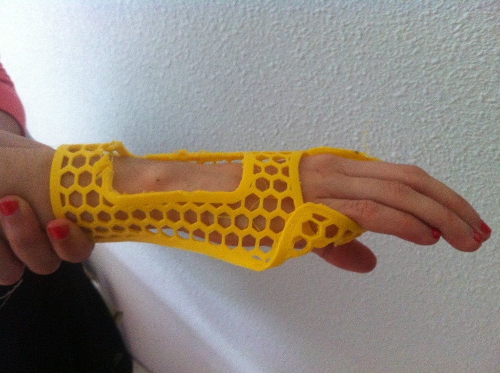 Free 3D file Cock-up splint ・3D print design to download・Cults